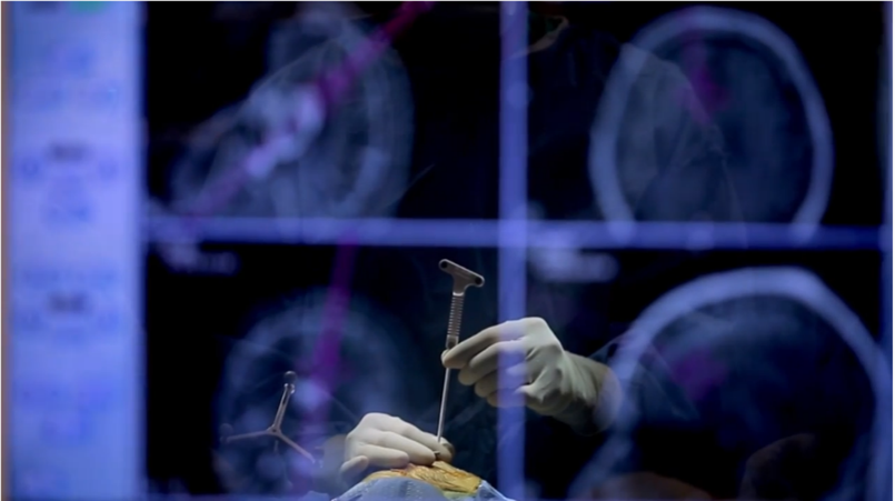 My Colloid Cyst Is Gone For Good” Neurological Surgery