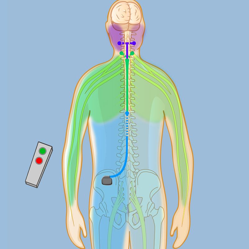 spinal-stimulation-lg.jpg | Neurological Surgery